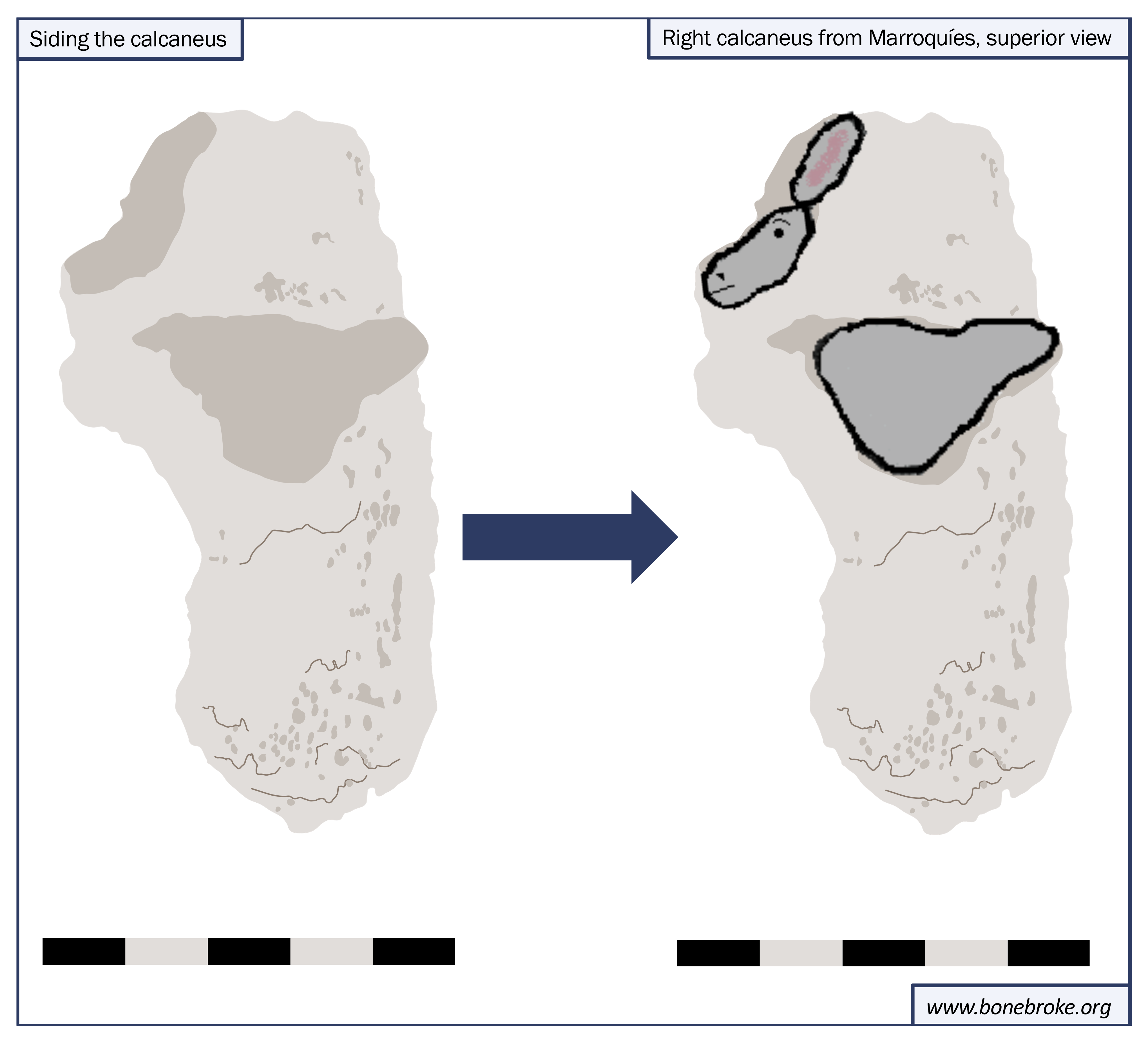 OsteoMenagerie 6: Tips for Siding the Calcaneus | Bone Broke